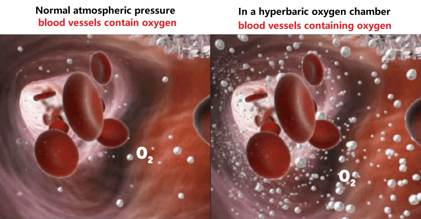 Hyperbaric Oxygen Therapy – Marseille Quincé